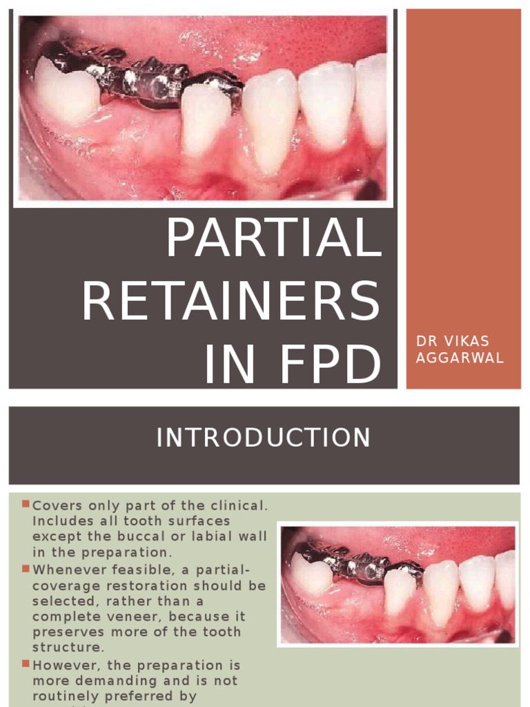 Partial Retainer in FPD DR Vikas | PDF | Tooth | Dental Anatomy