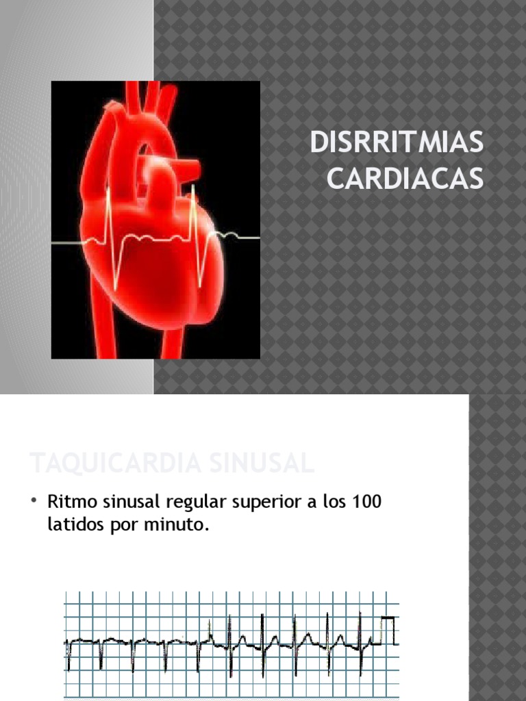 Disrritmias Cardiacas | PDF | Arritmia cardiaca | Cardiología