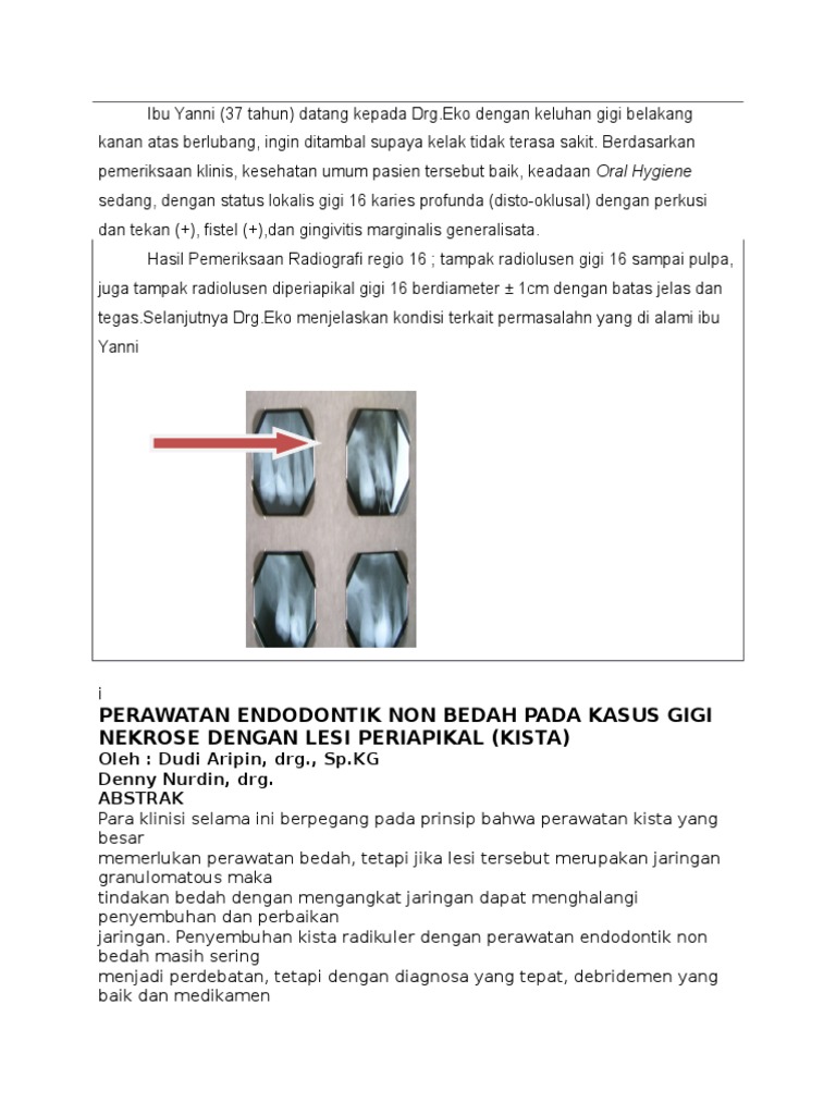 Perawatan Kista Gigi Non Bedah | PDF
