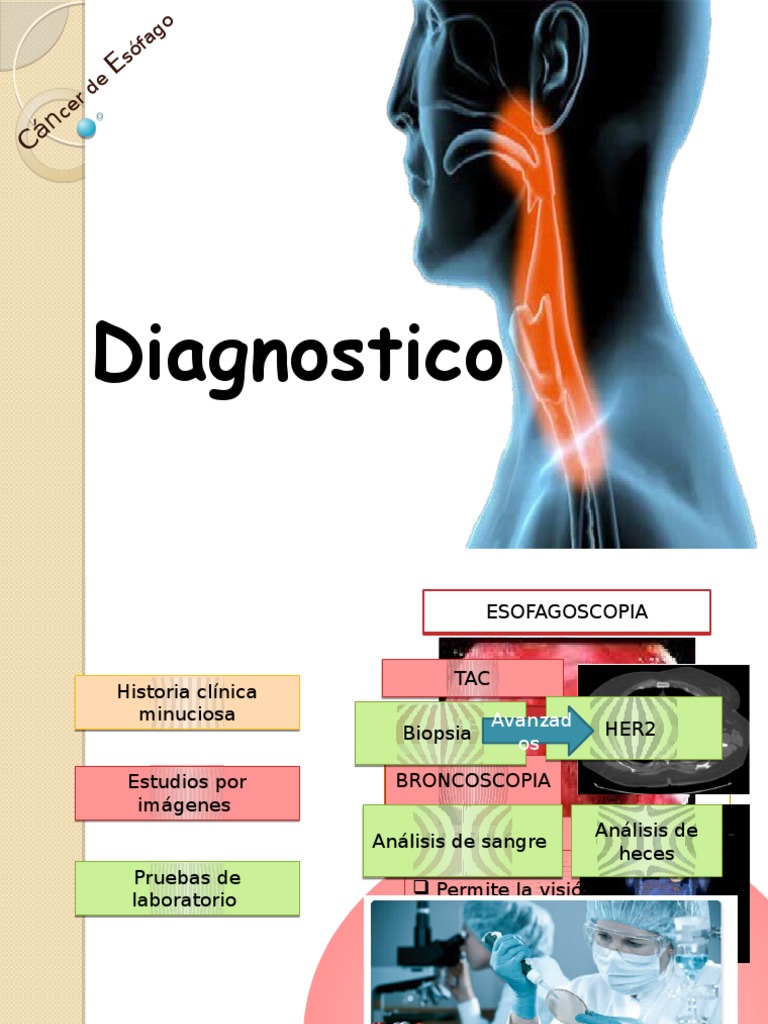 Cancer de Esofago( diagnostico y tratamiento) | Quimioterapia | Cáncer ...