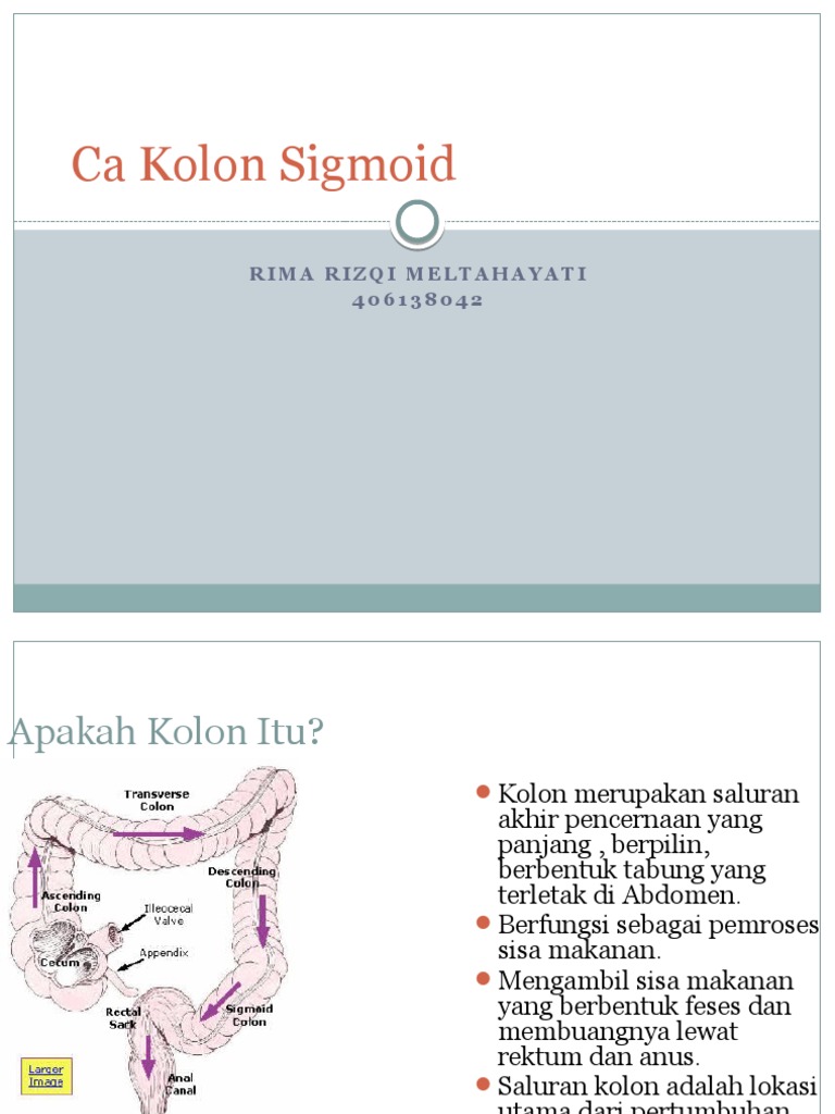 Referat CA Kolon Sigmoid