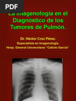 Signos Radiológicos Neumoperitoneo | PDF