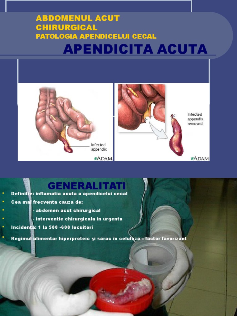 1.Apendicita-acuta.ppt