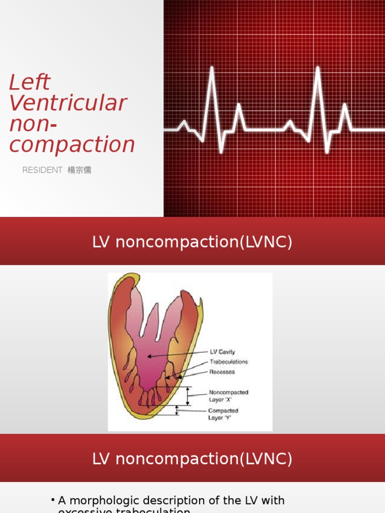 Left Ventricular Non-Compaction | PDF | Heart Failure | Heart