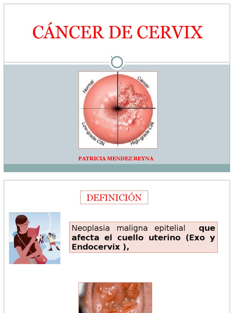 Cáncer de cervix | Vagina | Cáncer