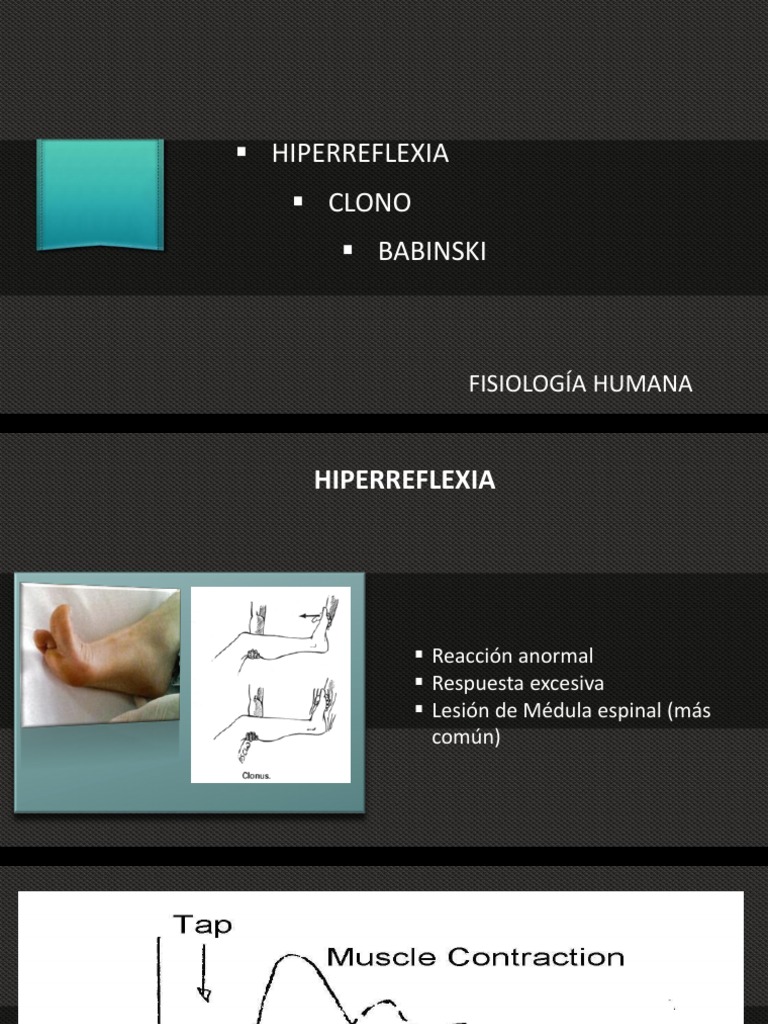Clonus y Hiperreflexia en Neurología | PDF | Enfermedades y trastornos ...