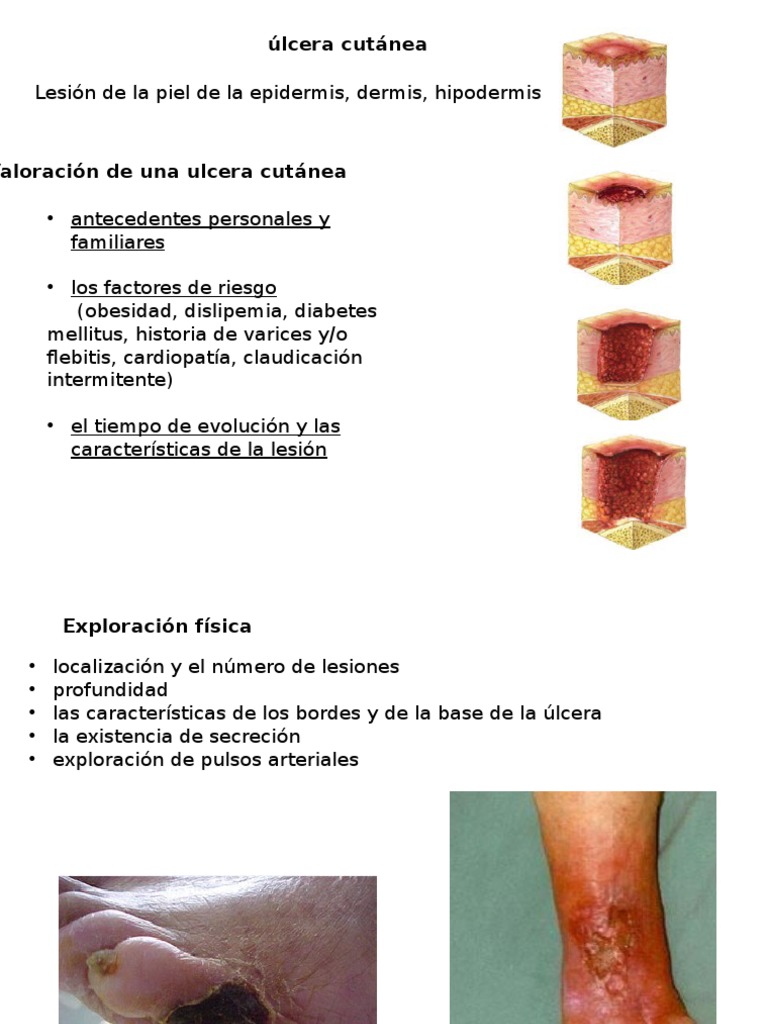 Ulceras Cutaneas | PDF