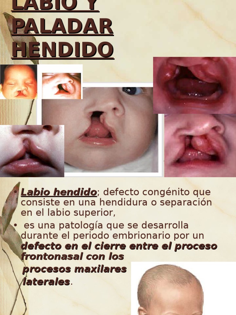 Labio y Paladar Hendido: Guía Completa | PDF | Especialidades Medicas ...
