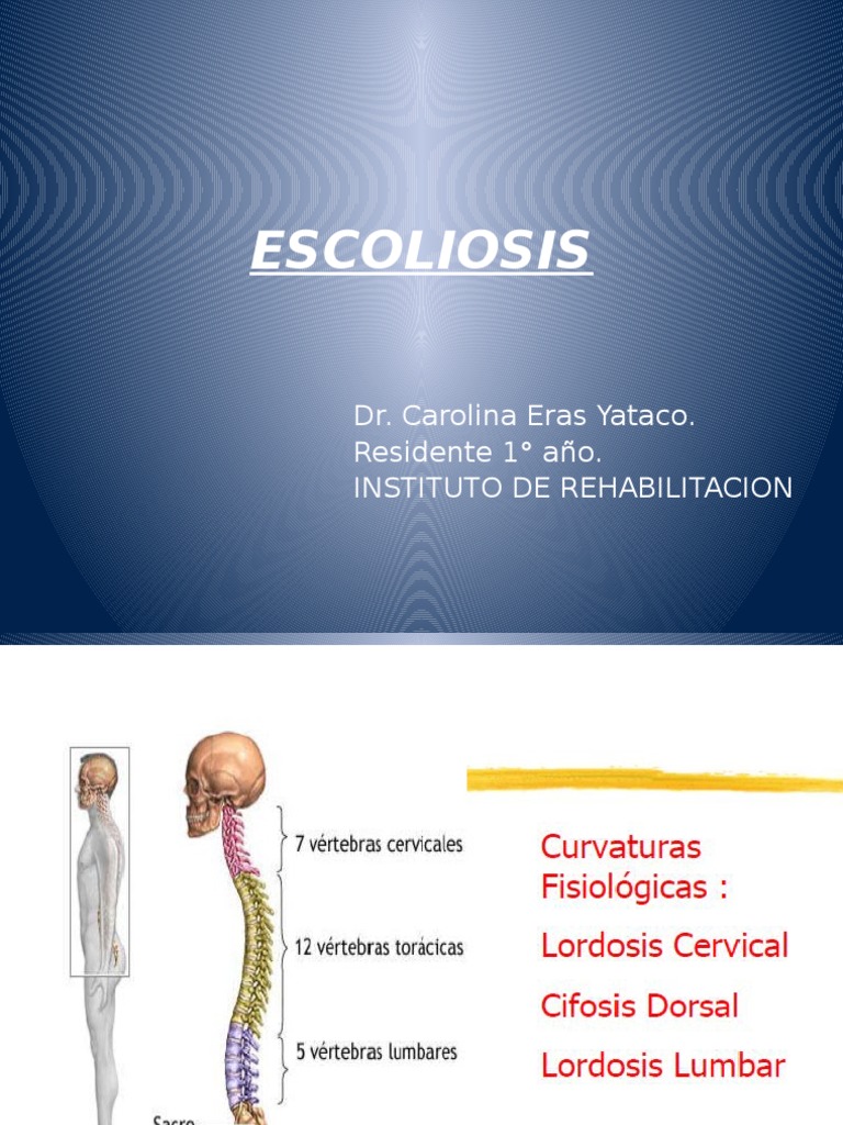 Escoliosis | Escoliosis | Vértebra