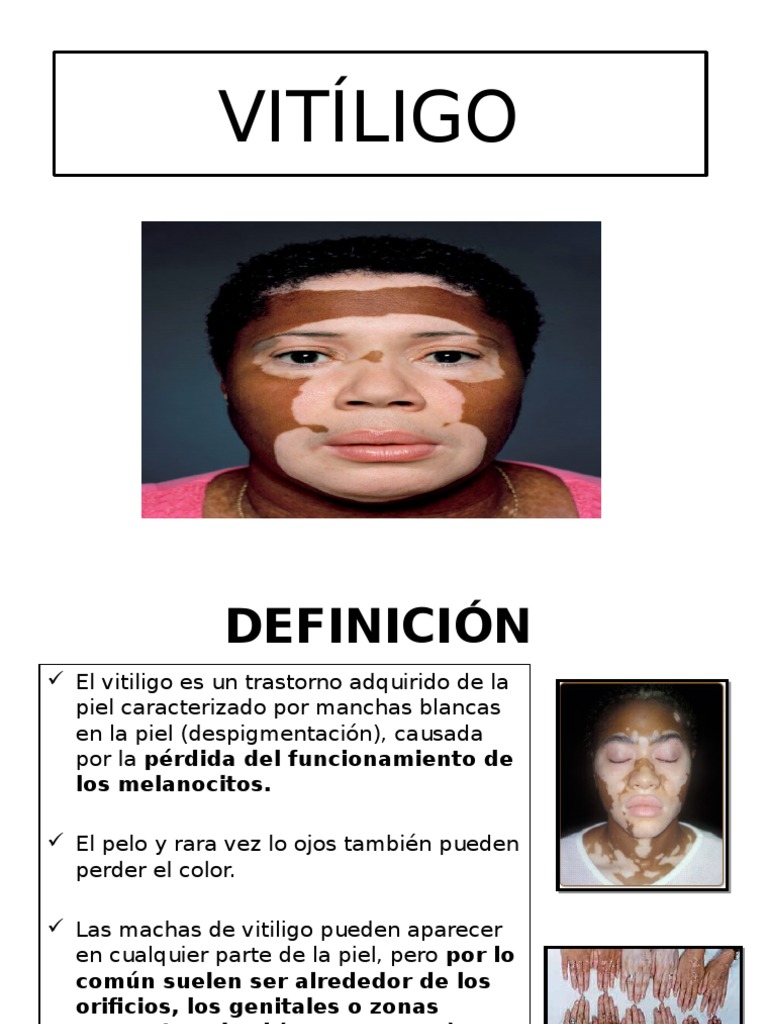 Vitiligo | PDF | Medicina CLINICA | Especialidades Medicas