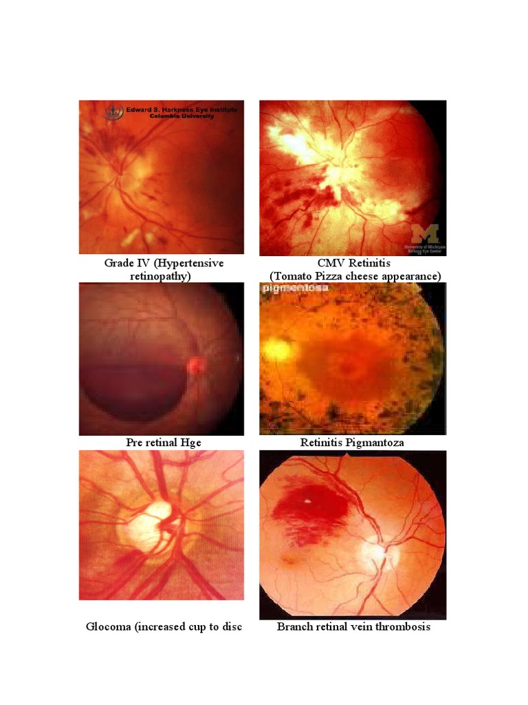 Labelled Fundus Pictures | PDF