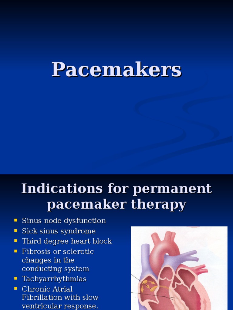 Pacemakers, Heart Blocks | PDF | Artificial Cardiac Pacemaker | Atrium ...