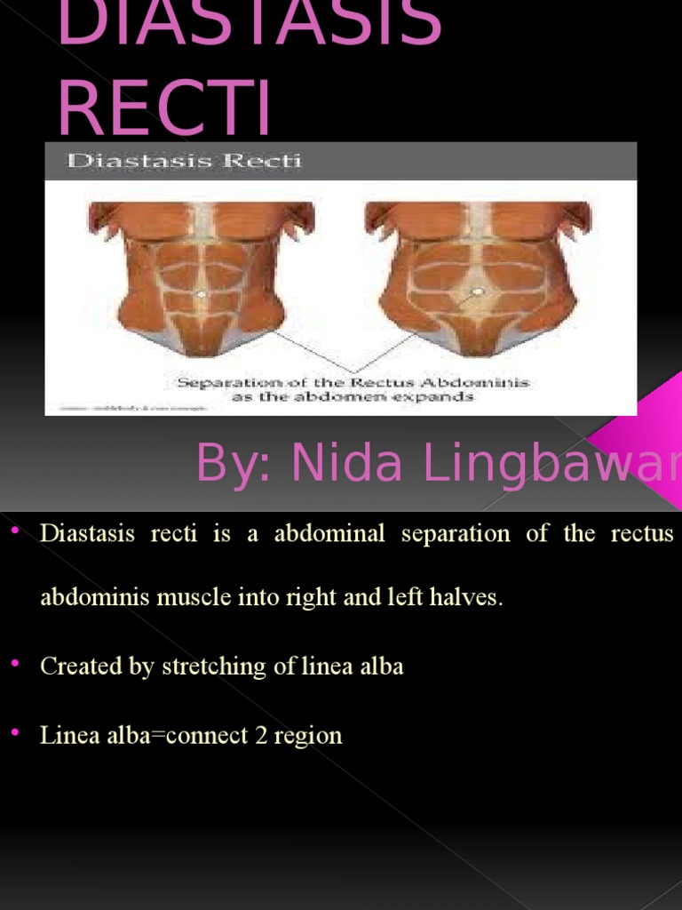 Diastasis Recti | Abdomen | Musculoskeletal System | Free 30-day Trial ...