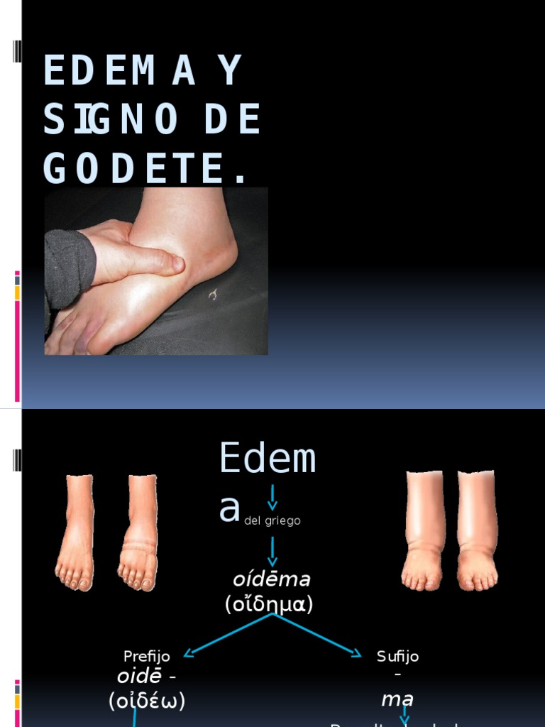 Edema y Signo de Godet