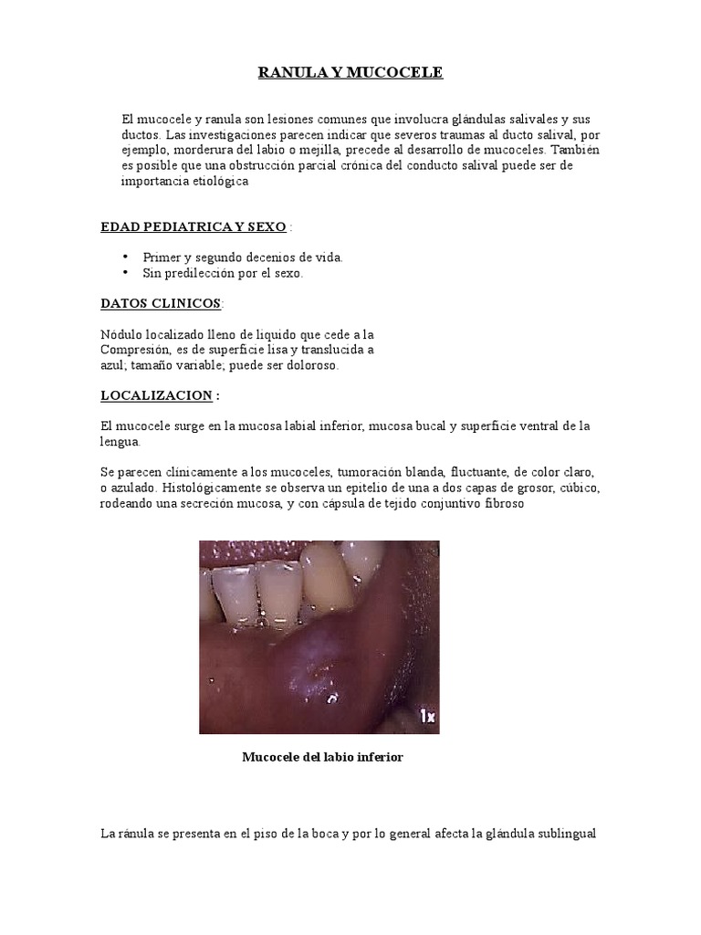 Ranula y Mucocele | PDF | Diente humano | Especialidades Medicas