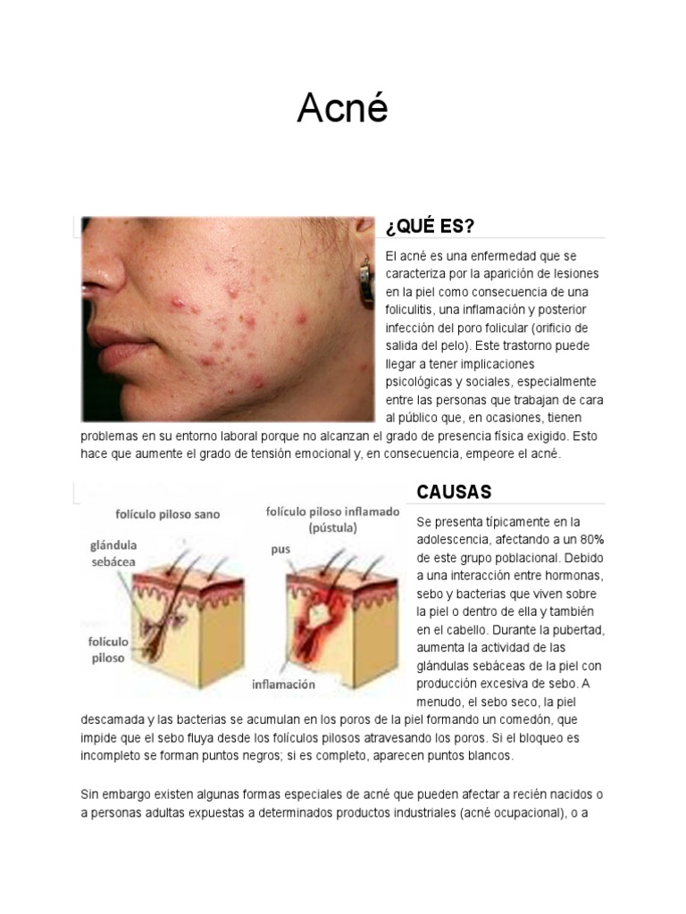 Acné | PDF | Acné común | Especialidades Medicas