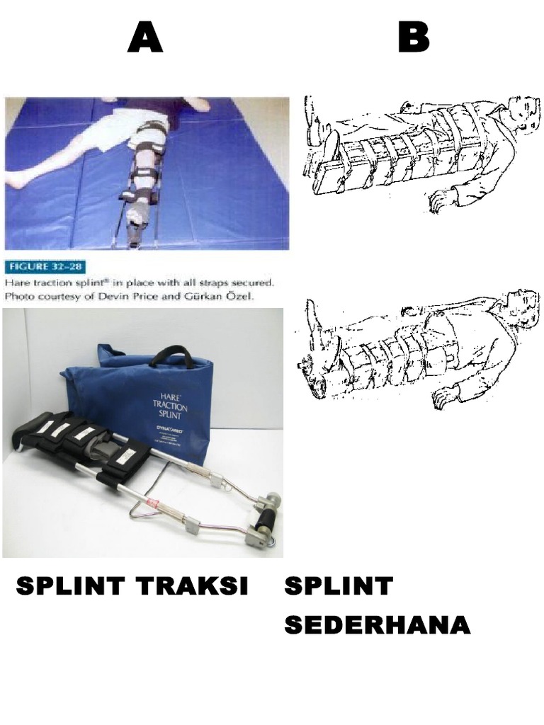 Splint Traksi Splint Sederhana | PDF