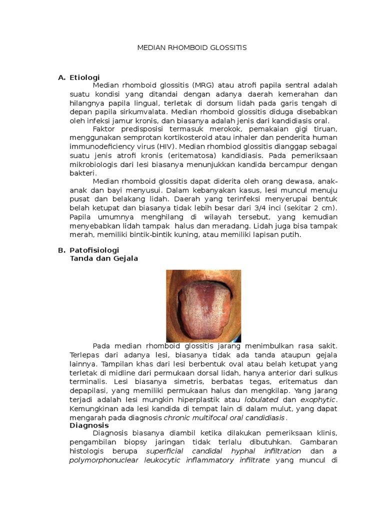 Median Rhomboid Glossitis | PDF