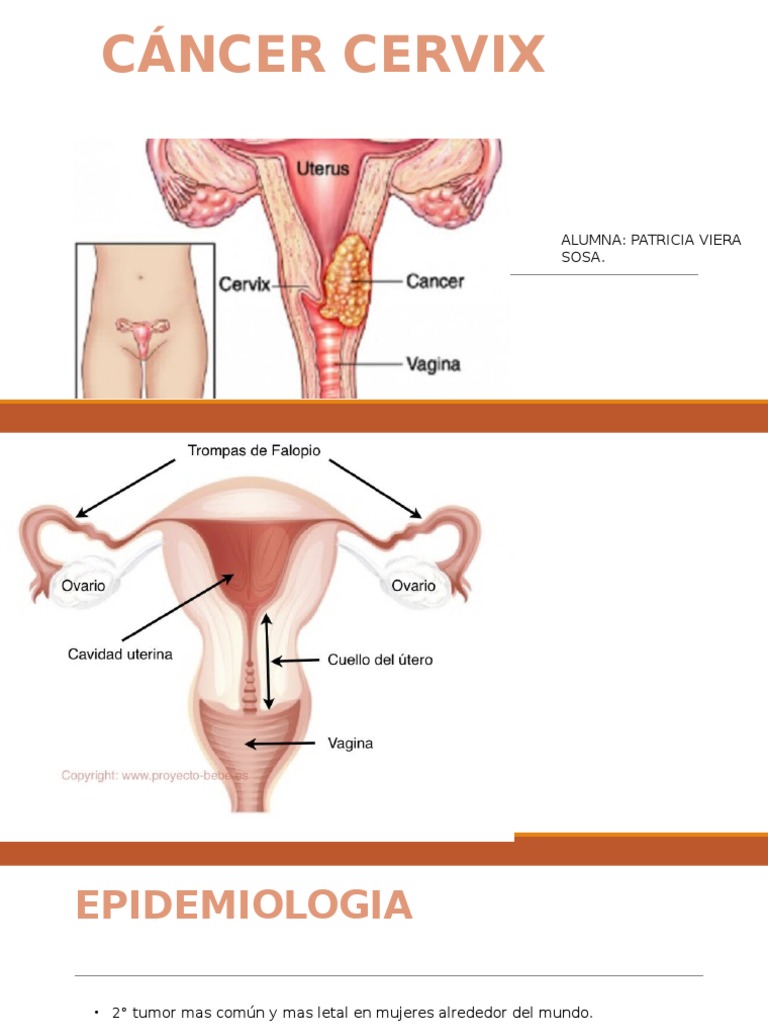 Cáncer Cervix | PDF | Cáncer de cuello uterino | Especialidades Medicas