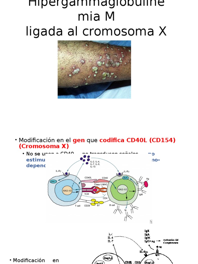 Hipergammaglobulinemia M y CD40L | PDF