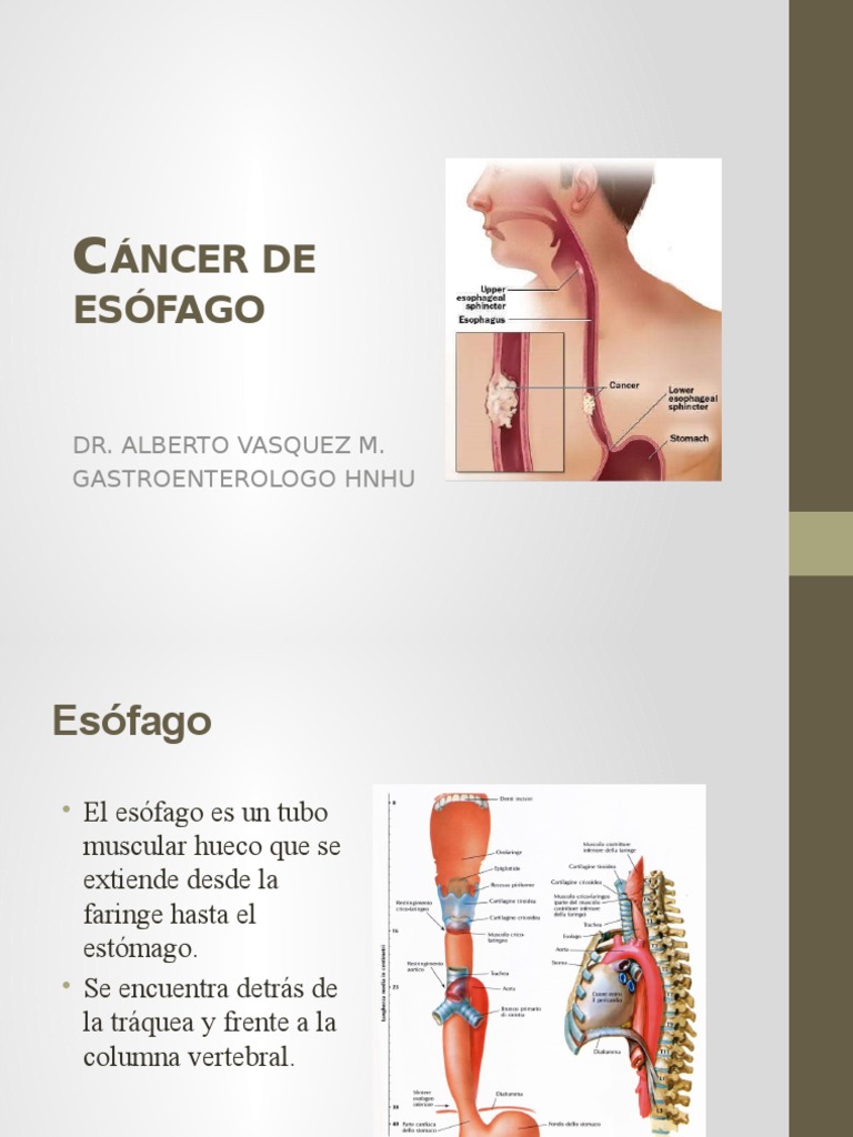 Cancer Esofagico | PDF | Cáncer de esófago | Cáncer