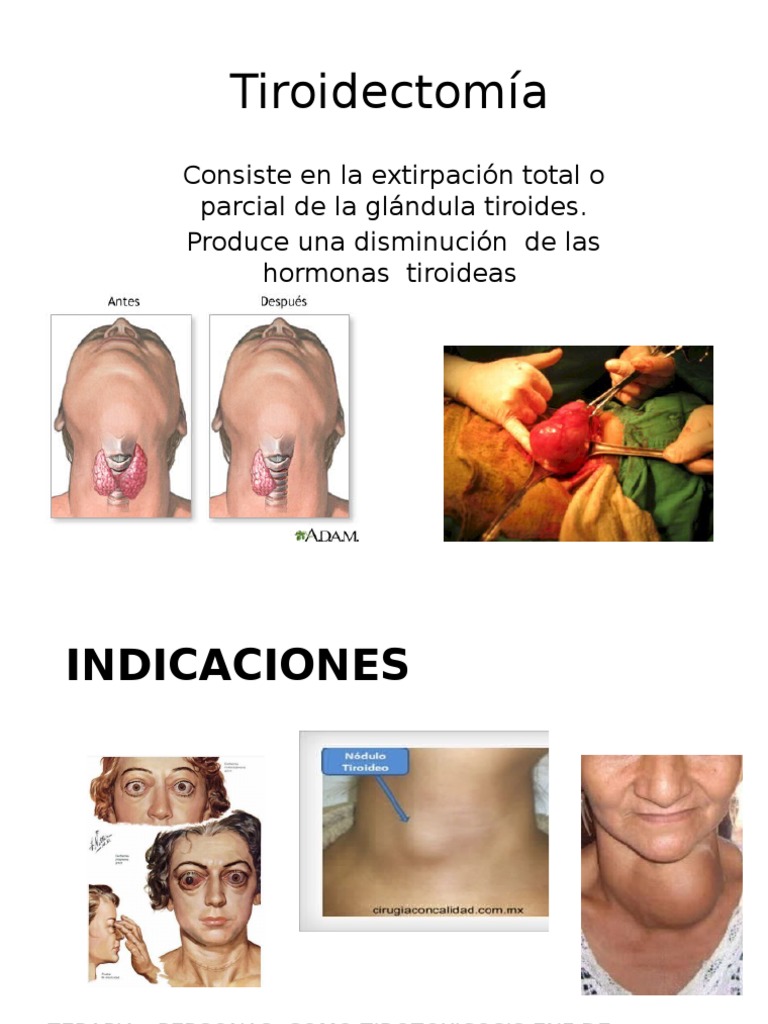 Tiroidectomía | PDF
