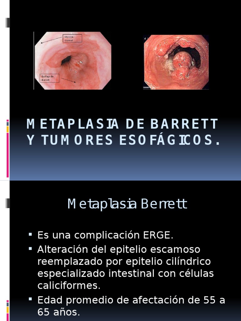Metaplasia | PDF | Cáncer de esófago | Metástasis