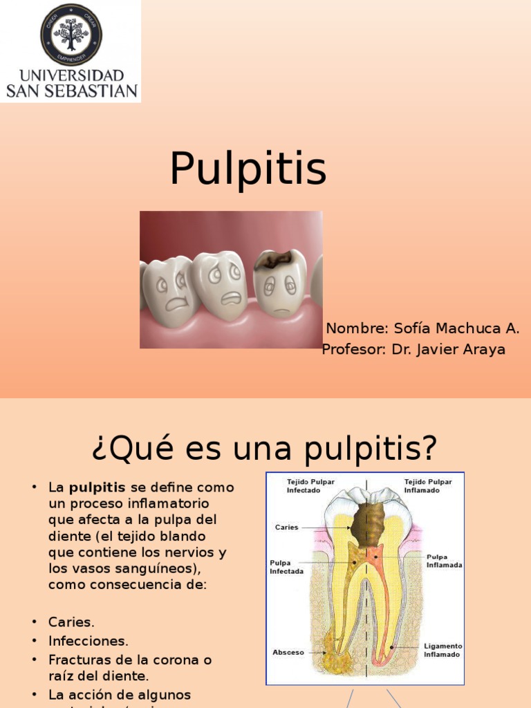 Pulpitis | PDF | Especialidades Medicas | Ciencias de la Salud