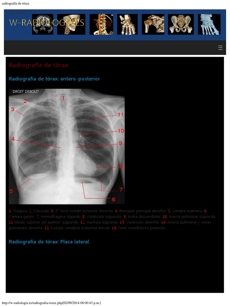 Anatomía De La Radiografía De Tórax Lateral Estructuras Básicas En
