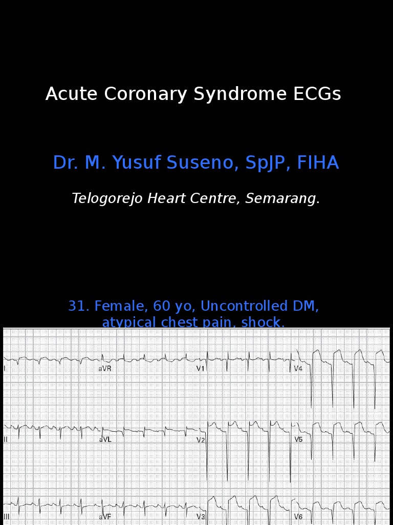 Acute Coronary Syndrome ECG Analysis | PDF