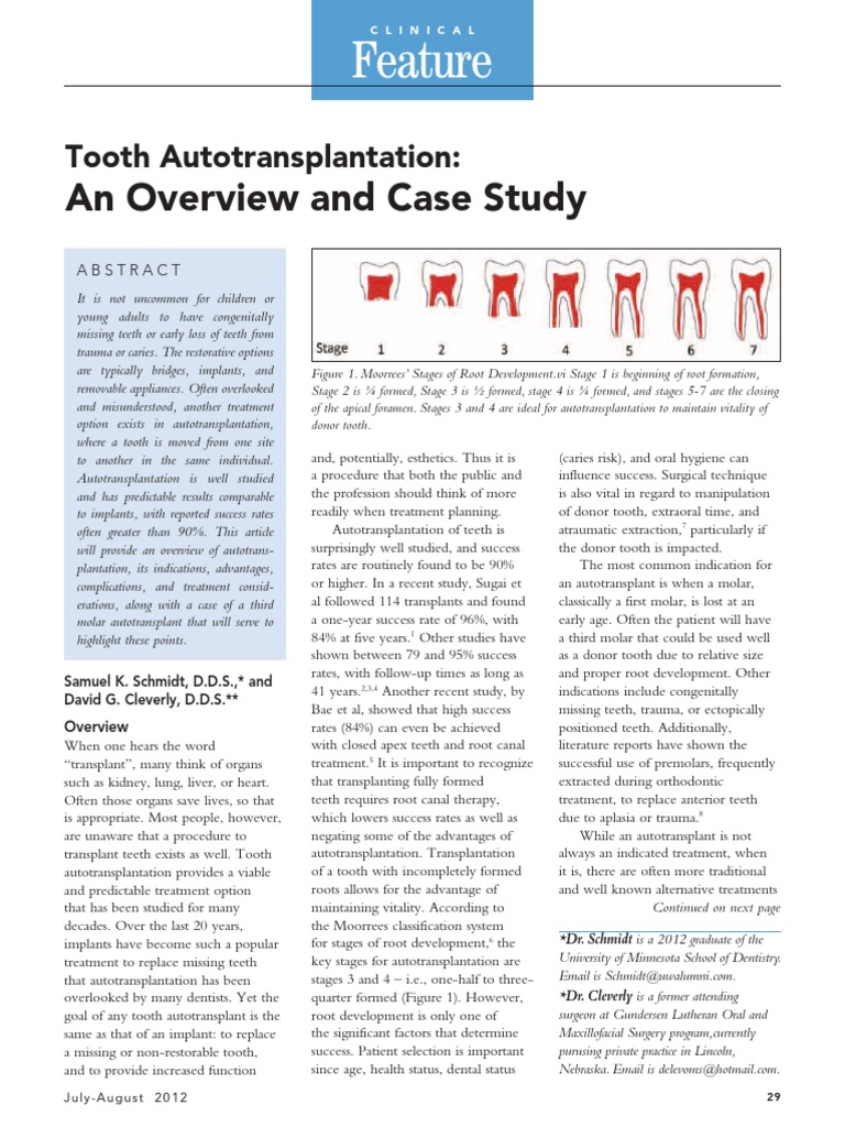 Tooth Autotransplantation | Dental Implant | Dentistry