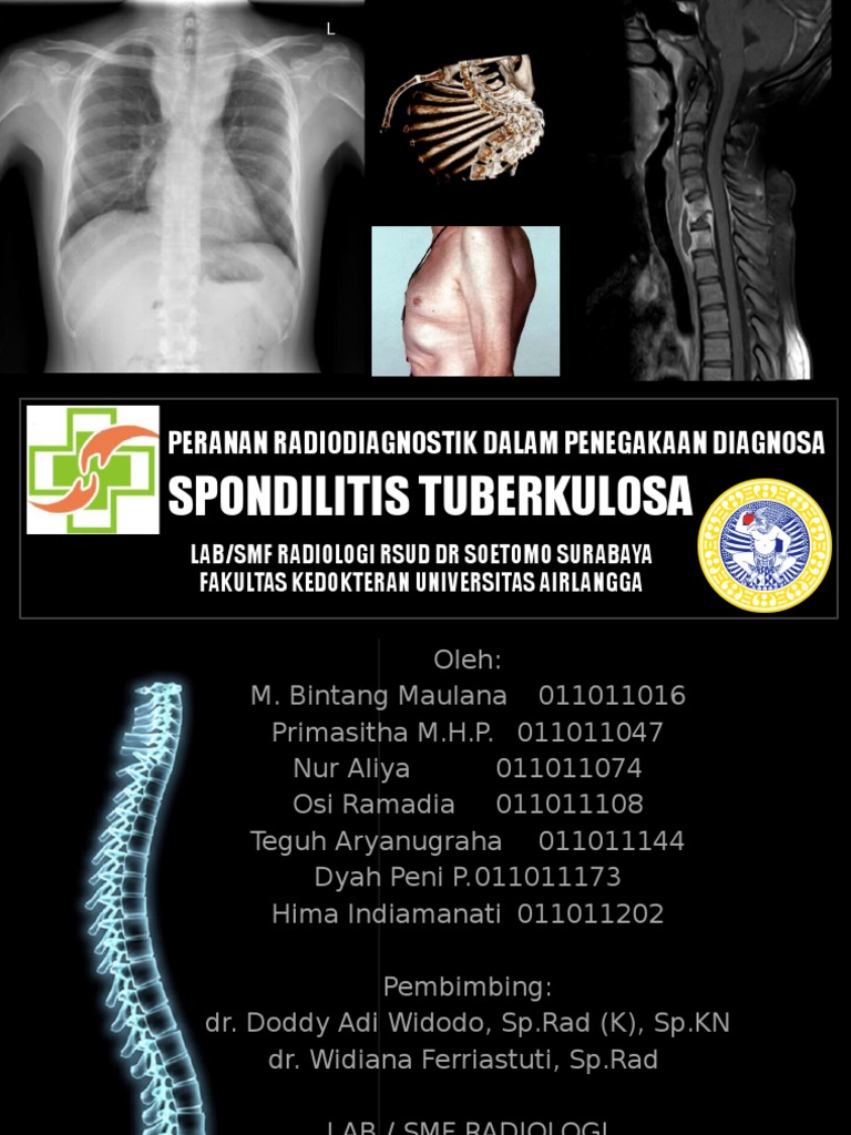 Spondilitis TB | PDF
