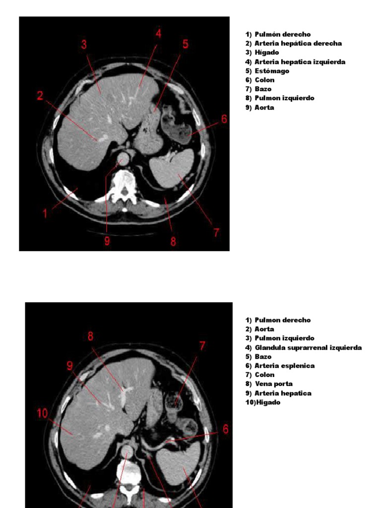 TAC de abdomen | Abdomen | Intestino grueso