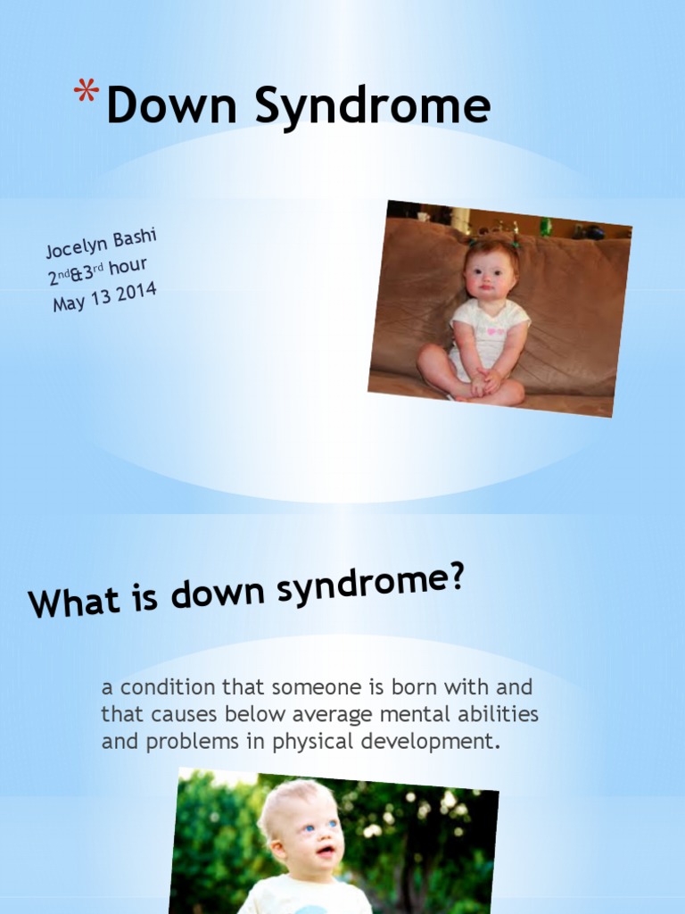 Down Syndrome | PDF