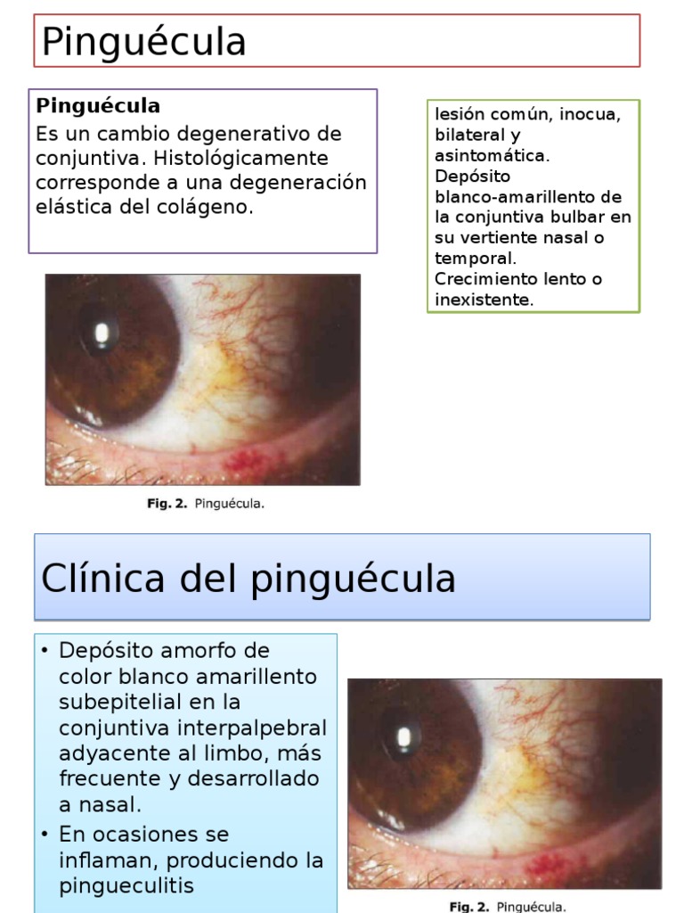 Pinguécula y Pterigion | PDF | Especialidades Medicas | Medicina CLINICA