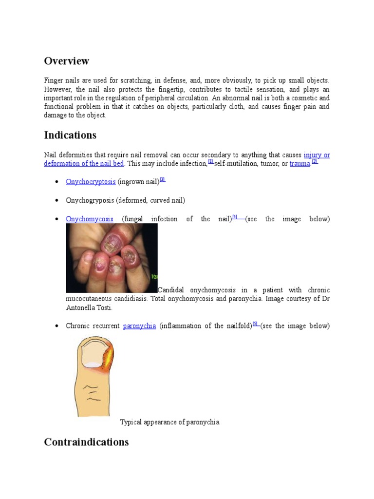 Nail Extraction | PDF | Anesthesia | Nail (Anatomy)