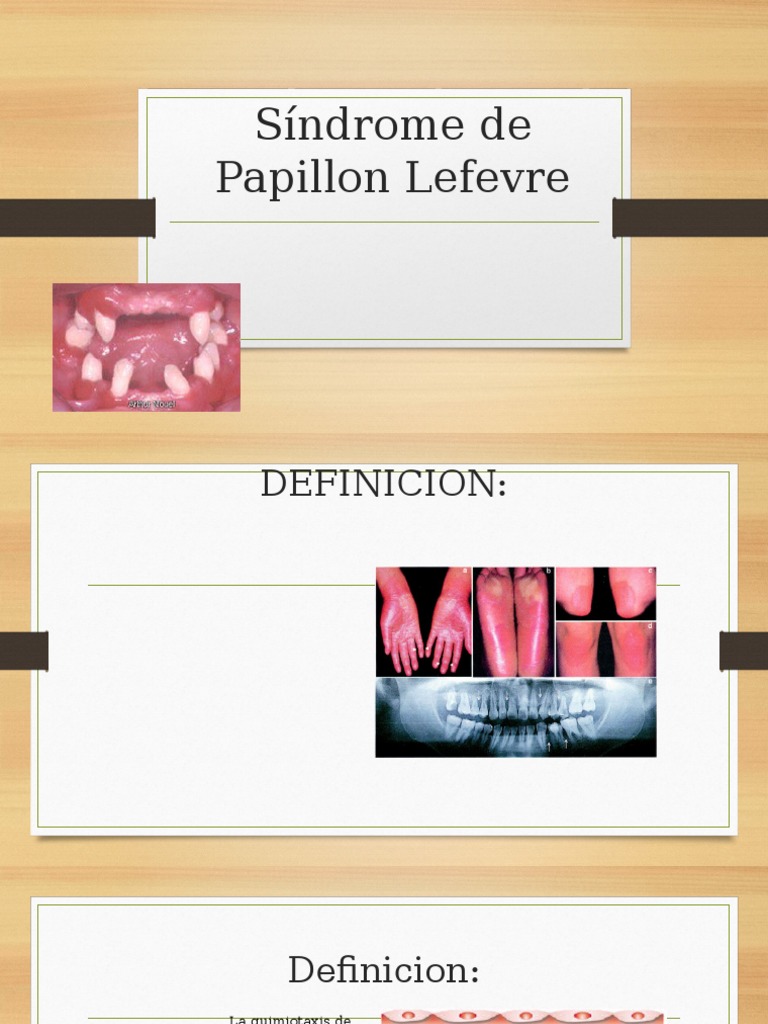 Sindrome Papillon Lefevre | PDF | Diente humano | Leucocito