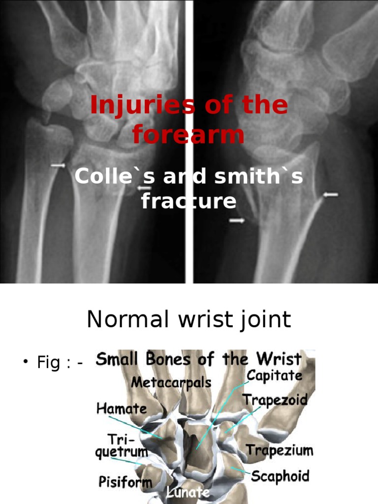 Fraktur Colles Dan Smith | Anatomical Terms Of Motion | Elbow