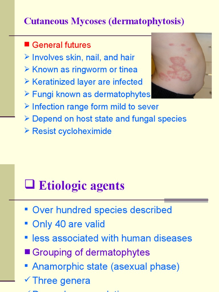 Cutaneous Mycoses Dermatophytosis Lecture Four | Microbiology | Immunology