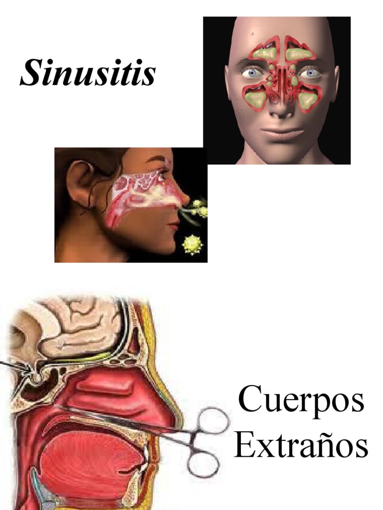 Sinusitis | PDF | Medicina | Enfermedades y trastornos