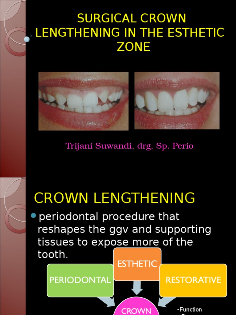 Surgical Crown Lengthening Techniques | PDF | Human Head And Neck ...