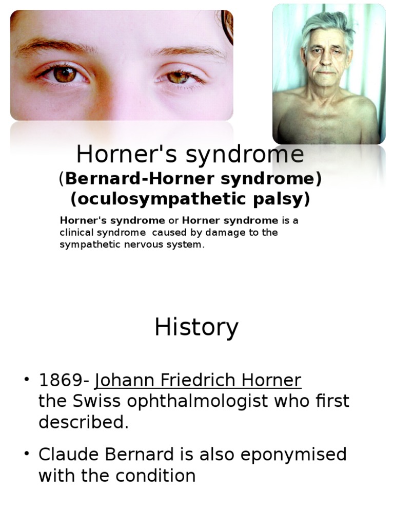 Overview of Horner's Syndrome | PDF | Human Head And Neck | Animal Anatomy