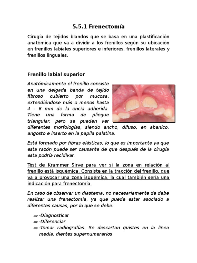 Frenectomia.docx | Human Tooth | Dentures