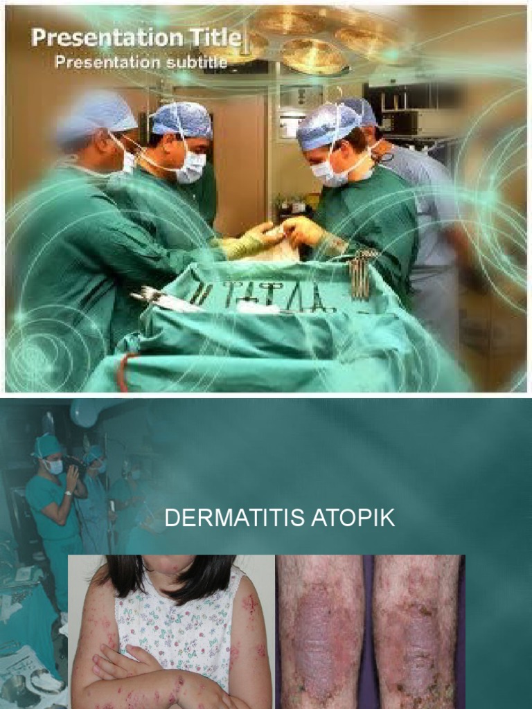 Dermatitis Atopik | PDF