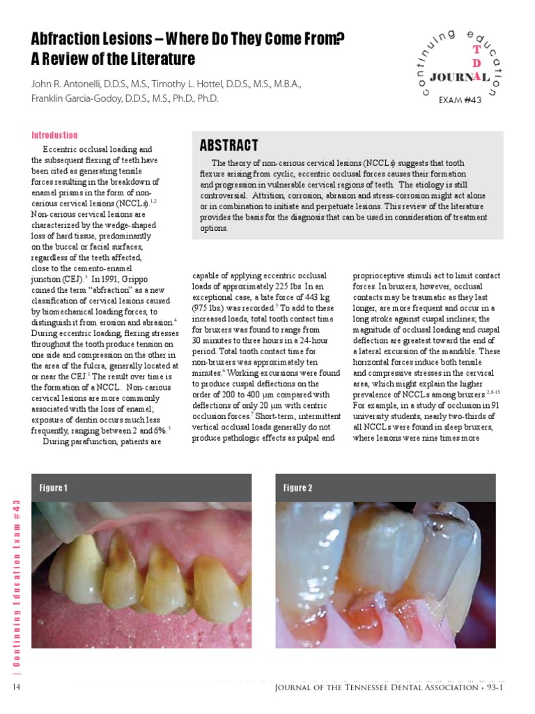 Abfraction Lesions - Where Do They Come From | Tooth Enamel | Dentistry ...