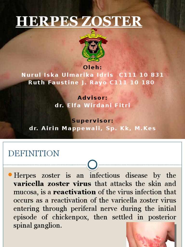 Herpes Zoster! | PDF | Herpes Simplex | Virology