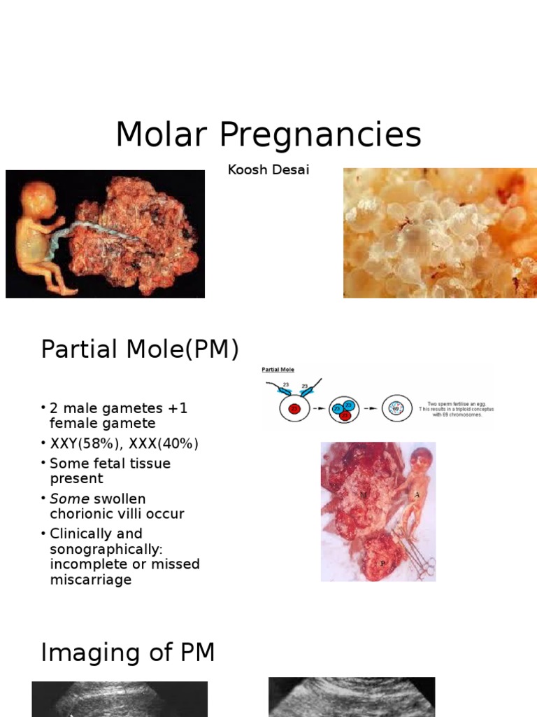 Molar Pregnancies | PDF