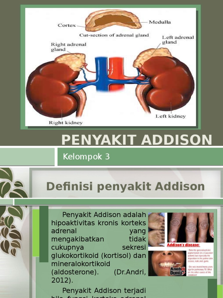 Penyakit Addison: Gejala dan Penanganan | PDF