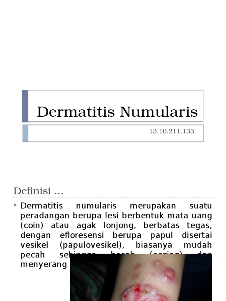 Dermatitis Numularis | PDF