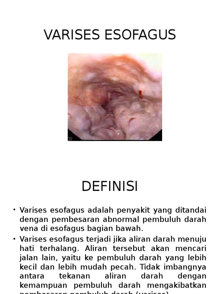 Varises Esofagus | PDF